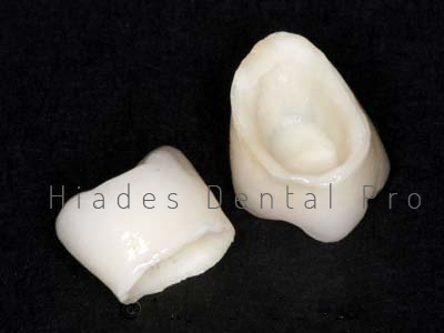coronas In-ceram - Hiades Dental Pro