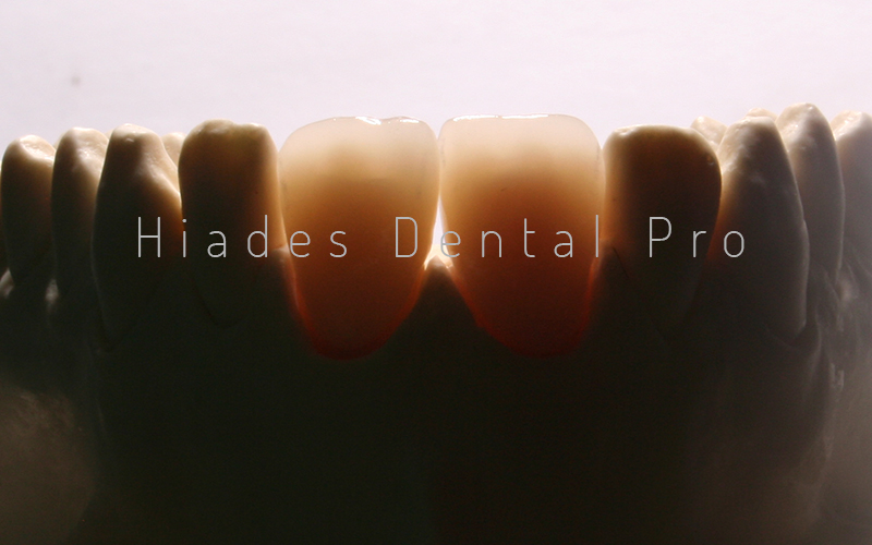 emaxpress - Hiades Dental Pro
