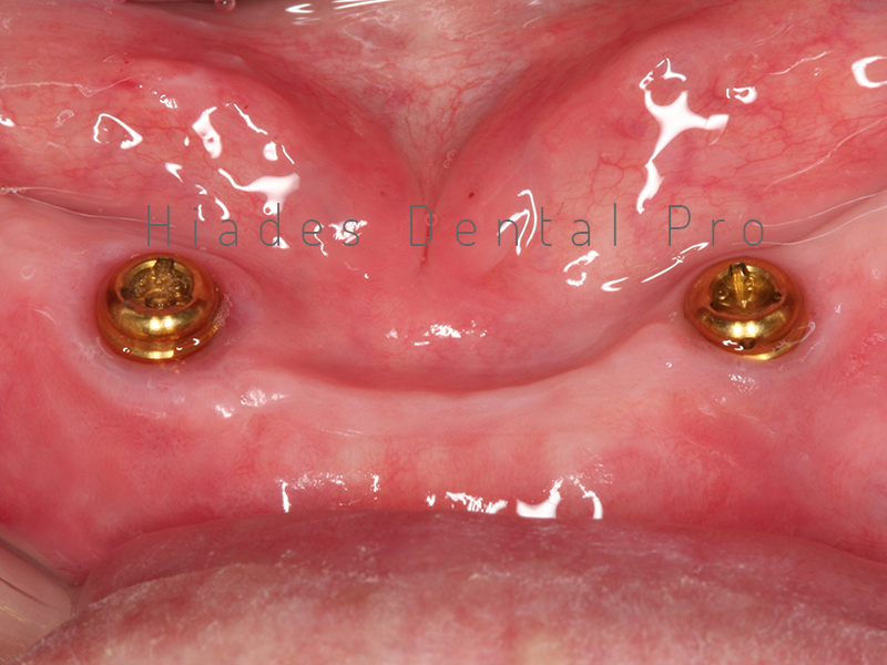 Prótesis sobre implantes - Hiades Dental Pro