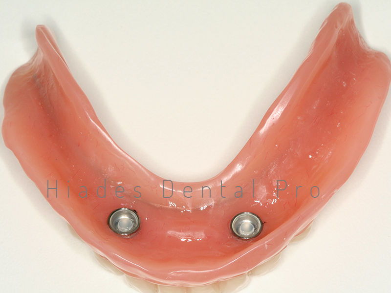 Prótesis sobre implantes - Hiades Dental Pro